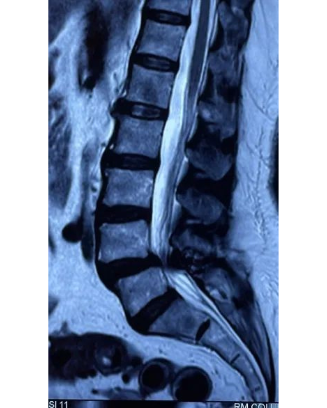 Espondilolistese - tipos, sintomas e fatores de risco